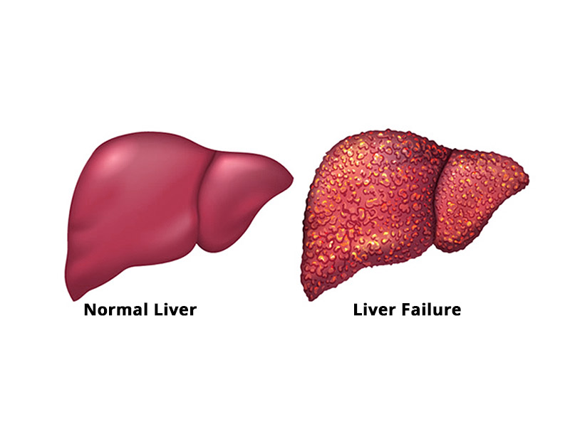 Acute Liver Failure Symptoms, Causes, Diagnosis and Treatment - Natural ...