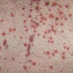 Idiopathic Thrombocytopenic Purpura Symptoms, Causes, Diagnosis and ...