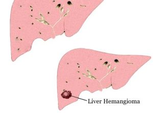 Liver Hemangioma Symptoms, Causes, Diagnosis and Treatment - Natural ...