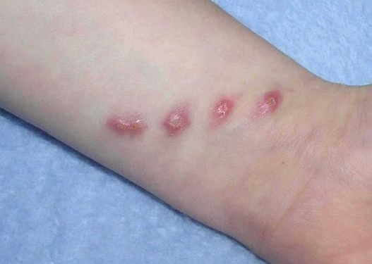 Bartonellosis Symptoms, Causes, Diagnosis and Treatment | Natural ...