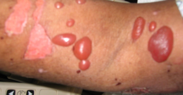 Chancroid Symptoms, Causes, Diagnosis and Treatment - Natural Health News