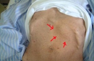 Chronic Lymphocytic Leukemia Symptoms, Causes, Diagnosis and Treatment ...