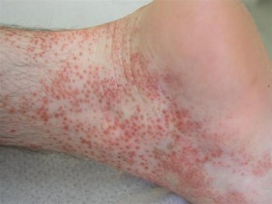 Lichen Nitidus Symptoms, Causes, Diagnosis and Treatment - Natural Health News