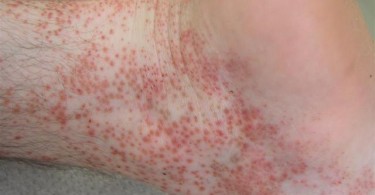 Lichen Sclerosus Symptoms, Causes, Diagnosis and Treatment - Natural ...
