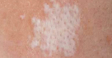 Lichen Nitidus Symptoms, Causes, Diagnosis and Treatment - Natural ...