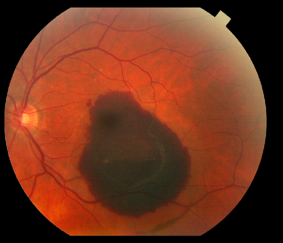 Wet Macular Degeneration Symptoms Causes Diagnosis And Treatment 