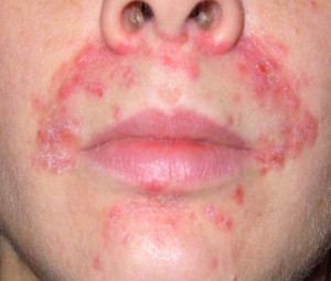 Perioral Dermatitis Symptoms, Causes, Diagnosis and Treatment - Natural ...