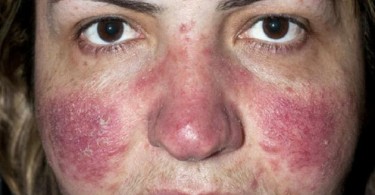 Rickets Symptoms, Causes, Diagnosis and Treatment - Natural Health News