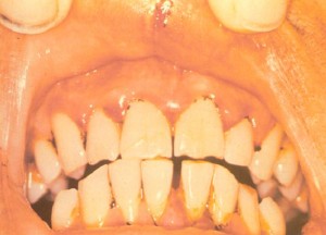 Scurvy Symptoms, Causes, Diagnosis and Treatment - Natural Health News