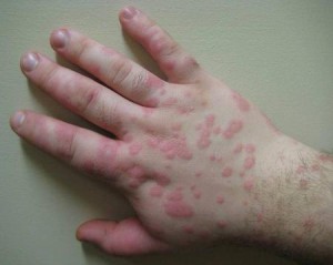 Valley Fever Symptoms, Causes, Diagnosis and Treatment - Natural Health ...