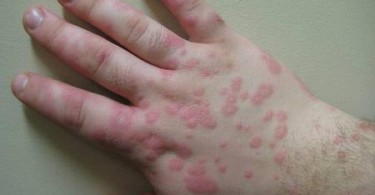 Uterine Fibroids Symptoms, Causes, Diagnosis and Treatment - Natural ...