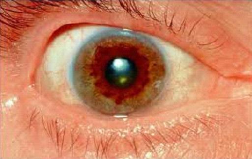 Wilson’s Disease Symptoms, Causes, Diagnosis and Treatment - Natural ...