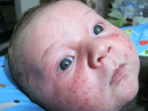Baby Acne Symptoms, Causes, Diagnosis and Treatment - Natural Health News
