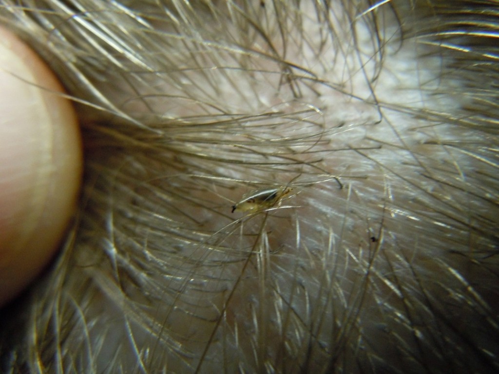 Lice Symptoms Causes Diagnosis And Treatment Natural Health News Lice Symptoms Causes Diagnosis And Treatment Natural Health News