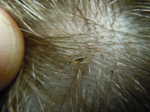 Lice Symptoms, Causes, Diagnosis and Treatment - Natural Health News
