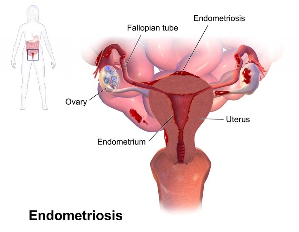 Endometriosis Symptoms, Causes, Complications, Diagnosis and Treatment ... Endometriosis Symptoms, Causes, Complications, Diagnosis and Treatment ...
