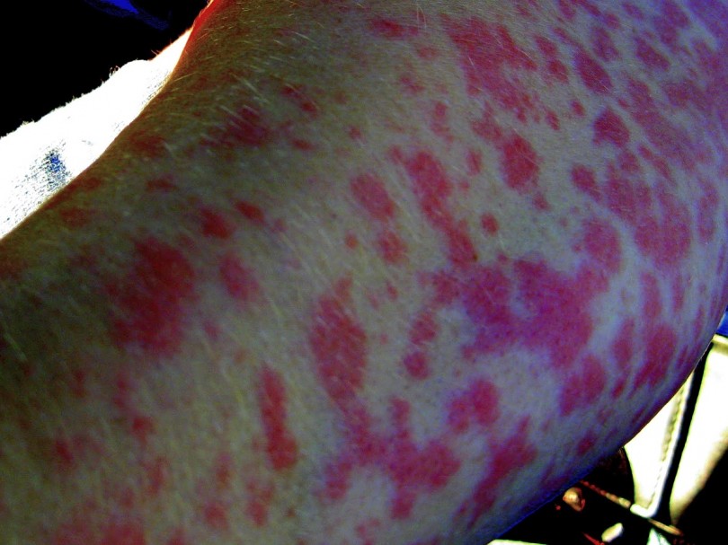 Penincillin Allergy Symptoms, Causes, Diagnosis and Treatment - Natural ...