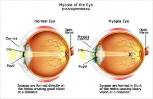 Myopia Symptoms, Causes, Diagnosis and Treatment - Natural Health News