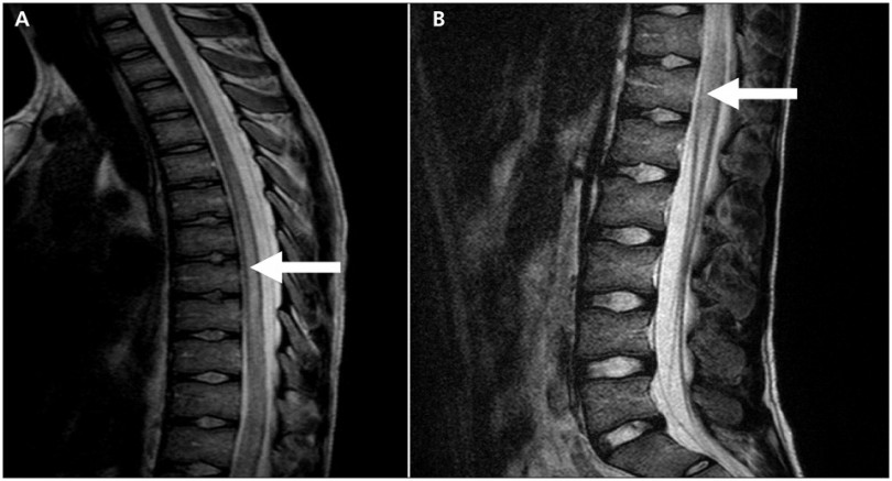 Transverse Myelitis Symptoms, Causes, Diagnosis and Treatment - Natural ...