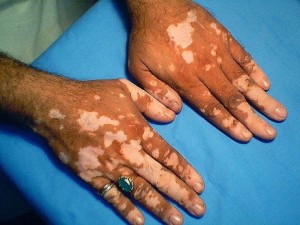 Vitiligo Symptoms, Causes, Diagnosis and Treatment - Natural Health News
