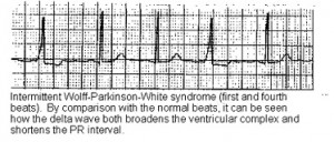 Wolff-Parkinson-White Syndrome Symptoms, Causes, Diagnosis and ...