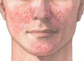 Acne Vulgaris Symptoms, Causes, Diagnosis and Treatment | Natural ...