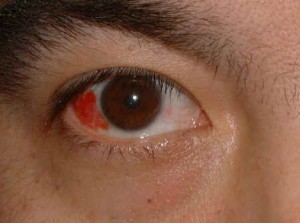 Subconjunctival Hemorrhage Causes, Symptoms, Diagnosis and Treatment ...