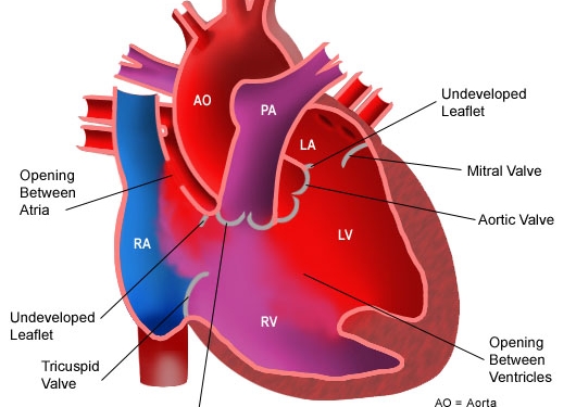Atrioventricular Canal Defect Causes, Symptoms, Diagnosis and Treatment ...