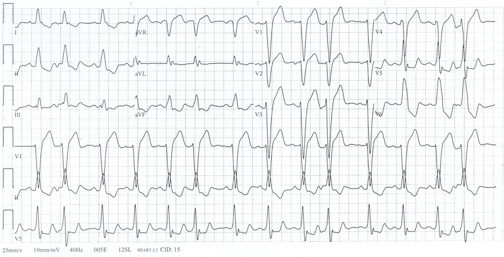 Bundle Branch Block Causes, Symptoms, Diagnosis and Treatment - Natural ...