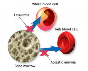 Aplastic Anemia Causes, Symptoms, Diagnosis and Treatment - Natural ...