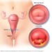 Cervicitis Causes, Symptoms, Diagnosis and Treatment - Natural Health News