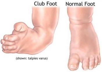 Clubfoot Causes, Symptoms, Diagnosis and Treatment - Natural Health News