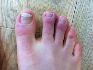Chilblains Causes, Symptoms, Diagnosis and Treatment - Natural Health News