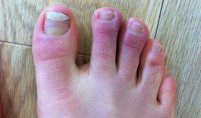 Chilblains Causes, Symptoms, Diagnosis and Treatment | Natural Health News