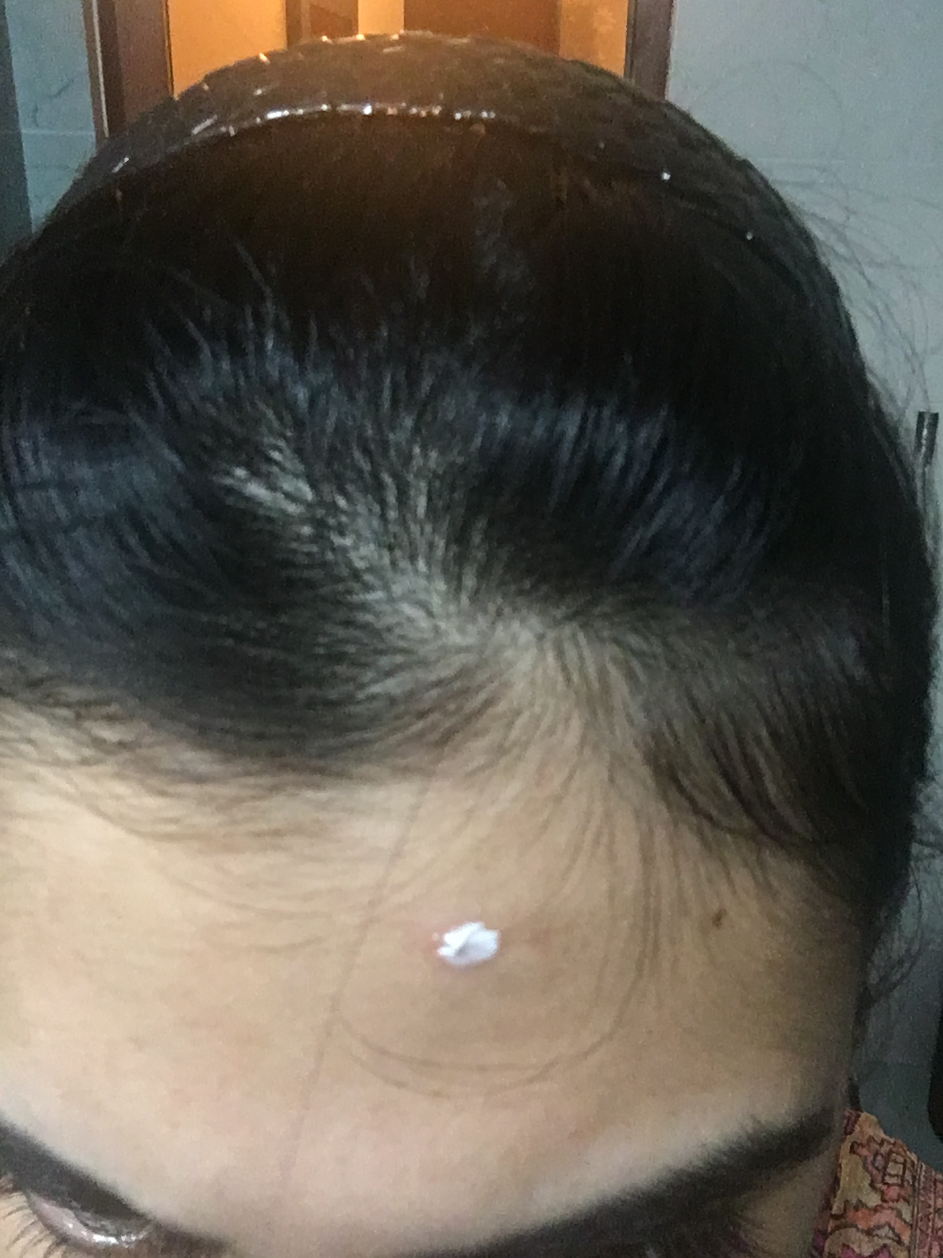 Acretin – 0.025% Tretinoin - Natural Health News