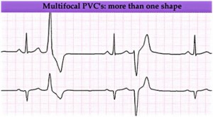 Premature Ventricular Contractions (PVC) Causes, Symptoms, Diagnosis ...