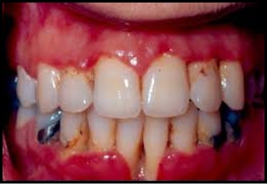 Trench Mouth Causes, Symptoms, Diagnosis and Treatment | Natural Health ...