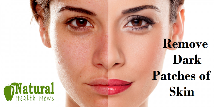 8 Tips to Remove Dark Patches of Skin | Natural Health News