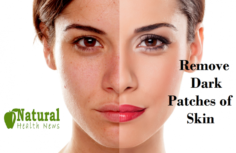 8 Tips to Remove Dark Patches of Skin - Natural Health News
