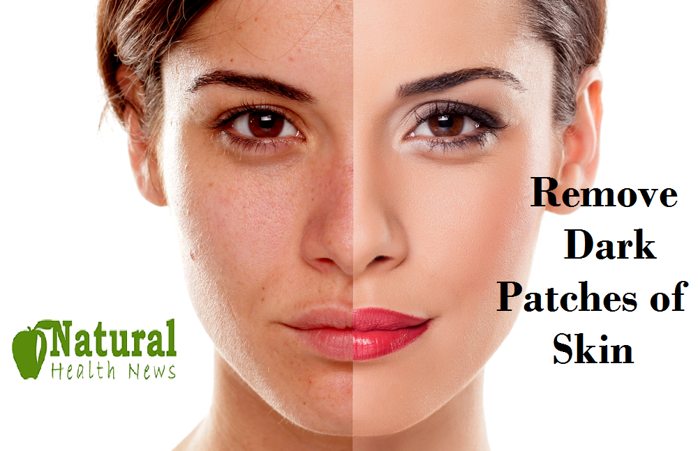 8 Tips To Remove Dark Patches Of Skin Natural Health News 8 Tips To Remove Dark Patches Of Skin Natural Health News