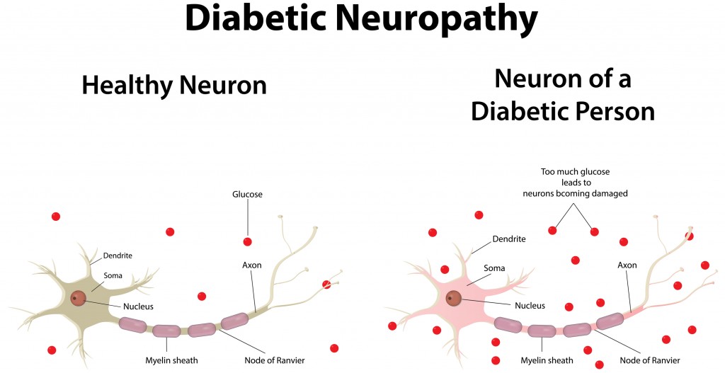 Diabetic Neuropathy Causes, Symptoms, Diagnosis and Treatment - Natural ... Diabetic Neuropathy Causes, Symptoms, Diagnosis and Treatment - Natural ...