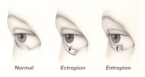 Entropion Causes, Symptoms, Diagnosis and Treatment | Natural Health News