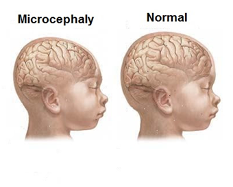 Microcephaly Causes, Symptoms, Diagnosis and Treatment | Natural Health ...