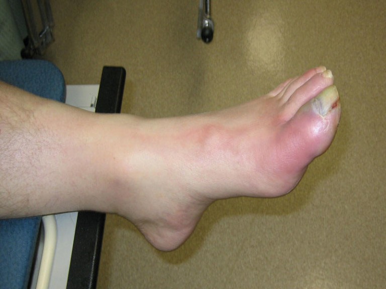 Osteomyelitis Causes, Symptoms, Diagnosis and Treatment - Natural ...