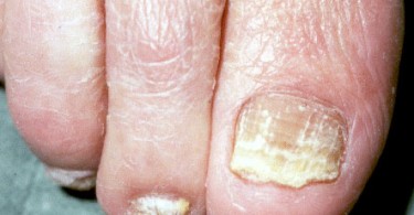 Tinea Faciei Causes, Symptoms, Diagnosis and Treatment - Natural Health ...