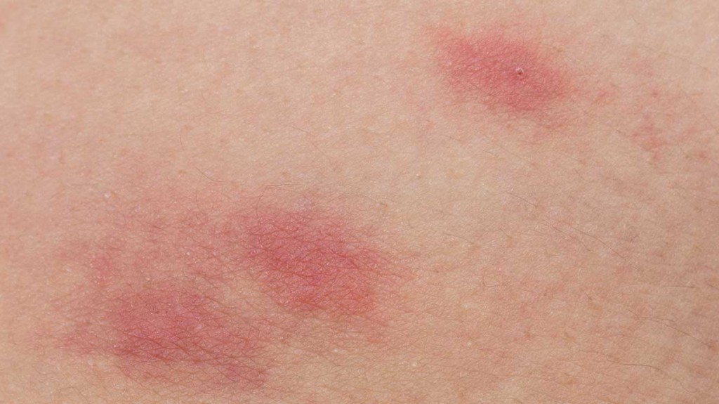 Skin Rash Symptoms, Causes, Diagnosis and Treatment - Natural Health News