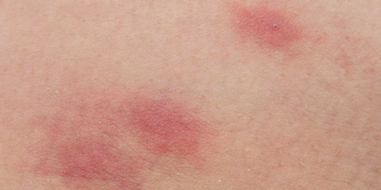 Skin Rash Symptoms, Causes, Diagnosis and Treatment | Natural Health News