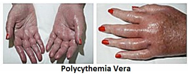 Natural Remedies for Polycythemia Vera to Get Rid of It