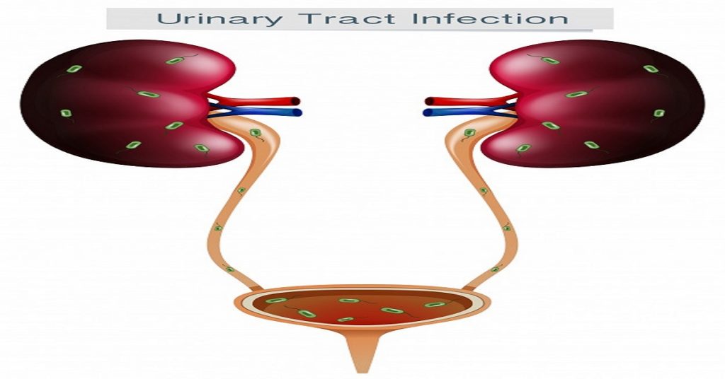 Bladder Cancer: Three Types and Treatments - Natural Health News