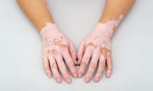 Researchers find hints about the vitiligo mechanism - Natural Health News
